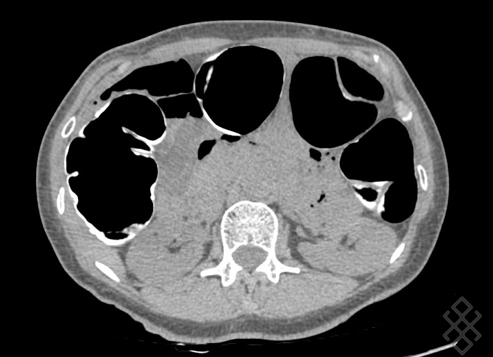 Coloscanner - Définition & Déroulement - Prise de rdv en ligne