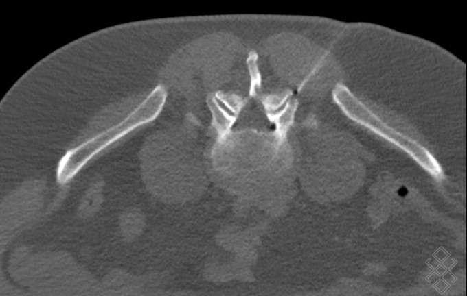 Infiltration Lombaire sous Scanner - Définition & Déroulement - Prise ...