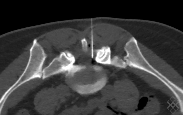 Infiltration Lombaire sous Scanner - Définition & Déroulement - Prise ...