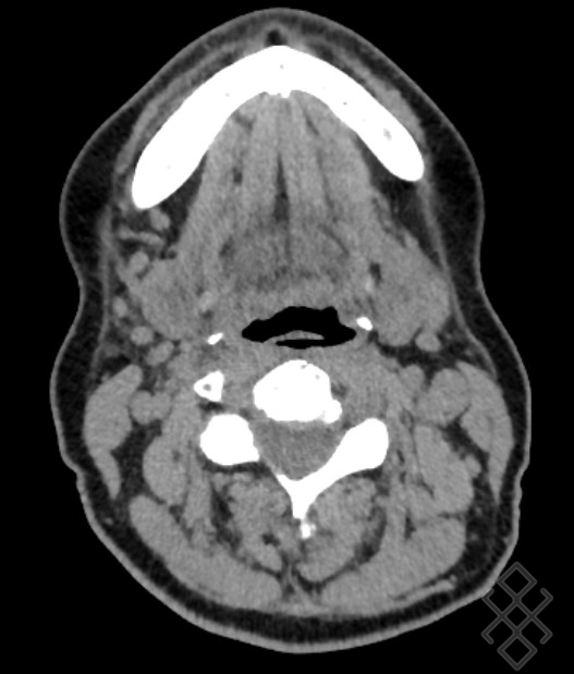 Scanner des Tissus Mous du Cou (cervico-facial) - Définition ...
