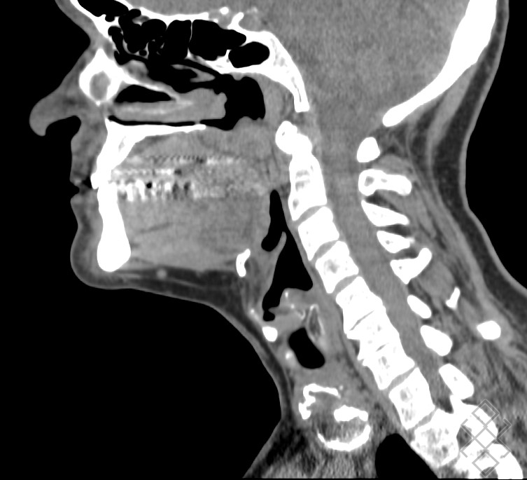 Scanner des Tissus Mous du Cou (cervico-facial) - Définition ...