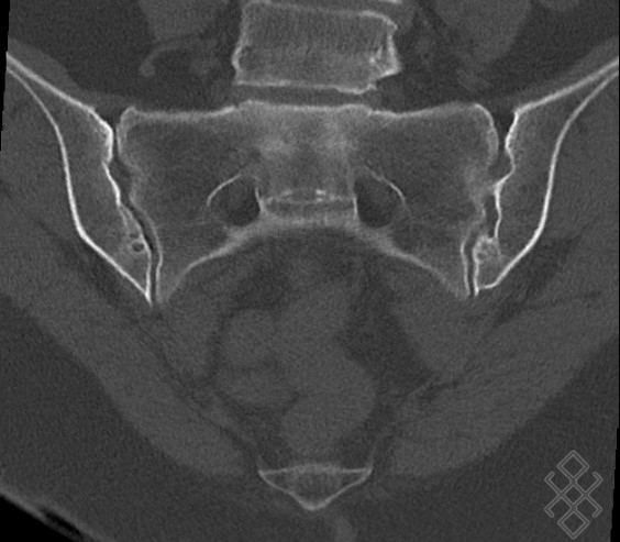 Scanner des Sacro-Iliaques - Définition & Déroulement - Prise de rdv en ...