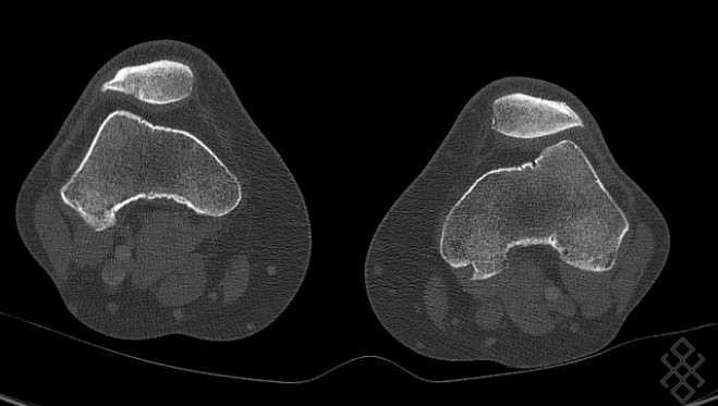Scanner du Genou - Définition & Déroulement - Prise de rdv en ligne