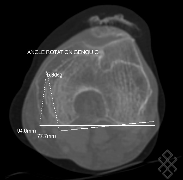 Scanner du Genou - Définition & Déroulement - Prise de rdv en ligne