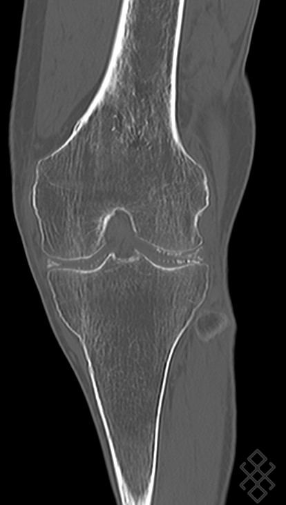 Scanner du Genou - Définition & Déroulement - Prise de rdv en ligne