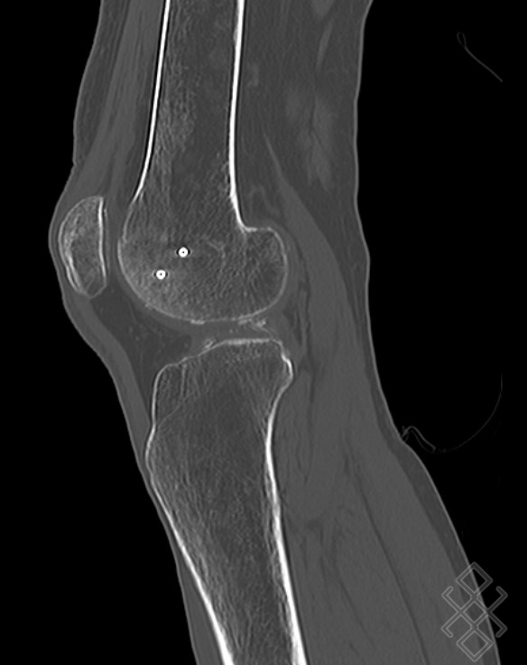 Scanner du Genou - Définition & Déroulement - Prise de rdv en ligne