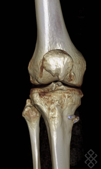 Scanner du Genou - Définition & Déroulement - Prise de rdv en ligne