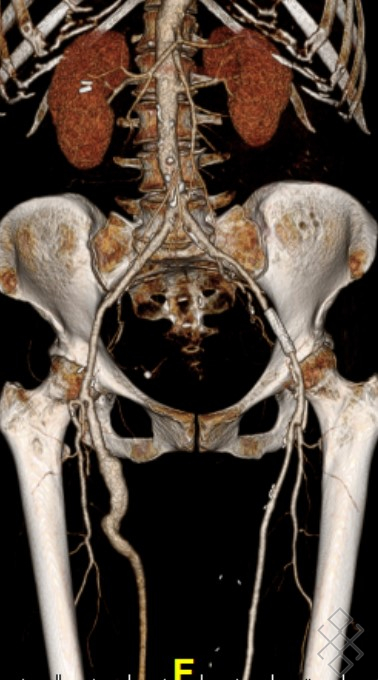 Angioscanner des Membres inférieurs - Définition & Déroulement - Prise ...