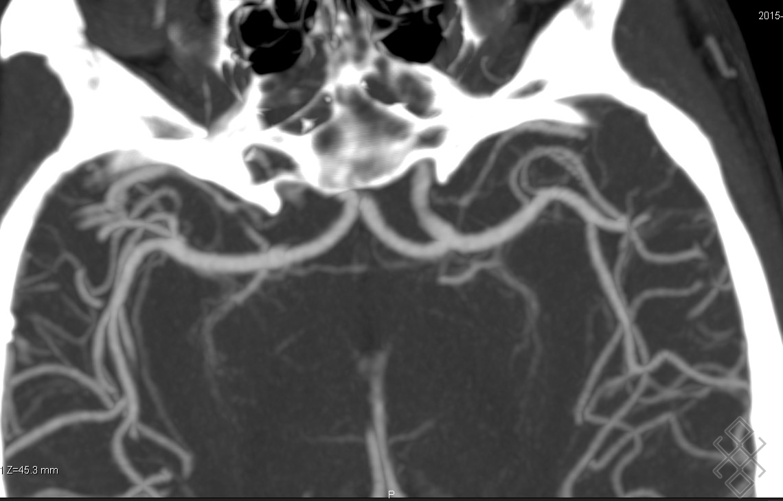 Angioscanner Cérébral - Définition & Déroulement - Prise de rdv en ligne