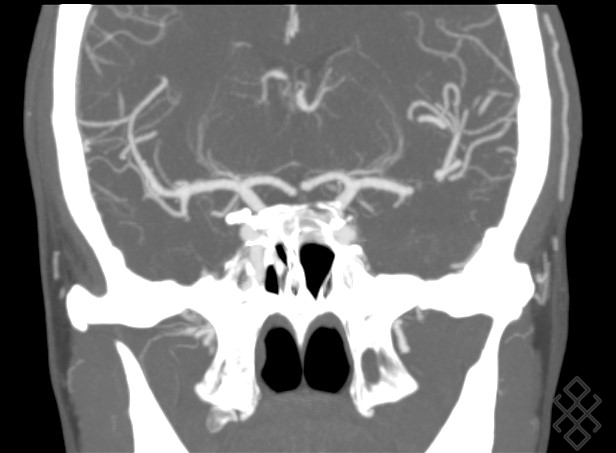 Angioscanner Cérébral - Définition & Déroulement - Prise de rdv en ligne