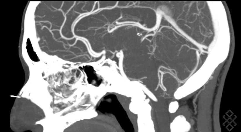 Angioscanner Cérébral - Définition & Déroulement - Prise de rdv en ligne
