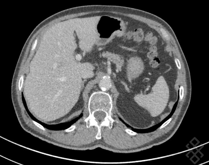 Scanner Thoraco-abdomino-pelvien - Définition & Déroulement - Prise de ...