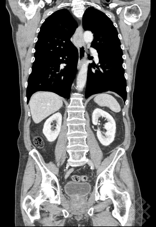 Scanner Thoraco-abdomino-pelvien - Définition & Déroulement - Prise de ...