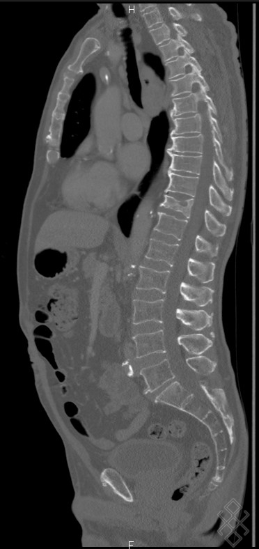 Scanner Thoraco-abdomino-pelvien - Définition & Déroulement - Prise de ...