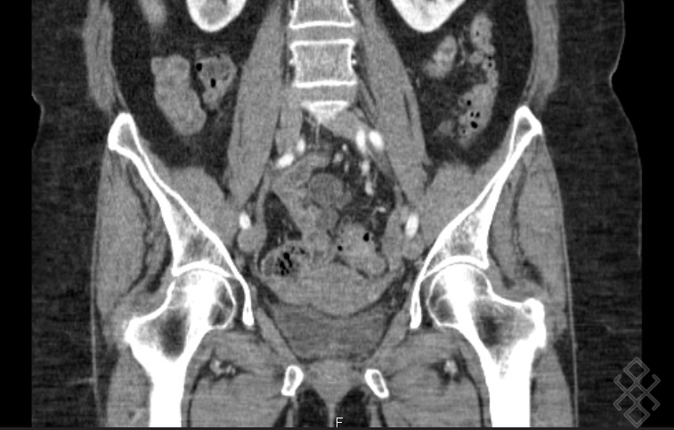 Pelviscan (Pelvimétrie) - Définition & Déroulement - Prise de rdv en ligne