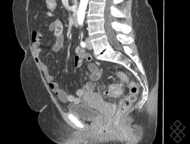 Pelviscan (Pelvimétrie) - Définition & Déroulement - Prise de rdv en ligne