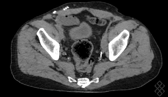Pelviscan (Pelvimétrie) - Définition & Déroulement - Prise de rdv en ligne