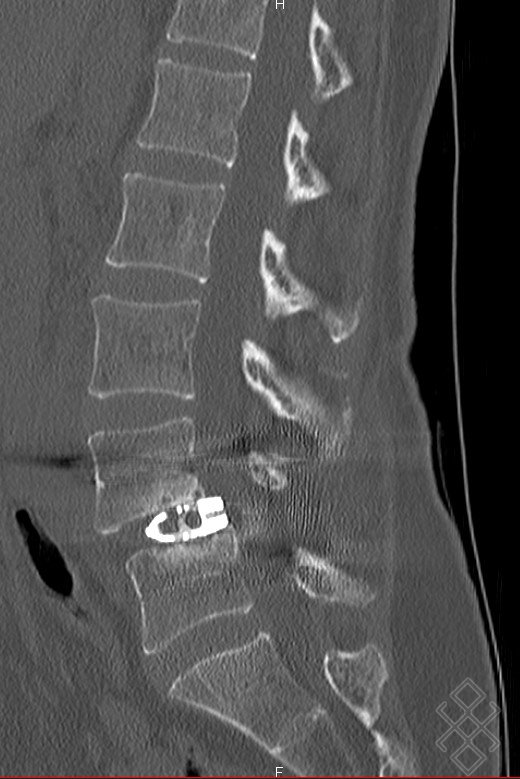 Scanner du Rachis lombaire - Définition & Déroulement - Prise de rdv en ...