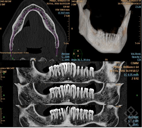 Scanner Dentaire (Dentascan) - Définition & Déroulement - Prise de rdv ...