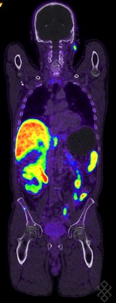 TEP-Scan au PSMA - Définition & Déroulement - Prise de rdv en ligne