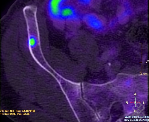 TEP-Scan au PSMA - Définition & Déroulement - Prise de rdv en ligne