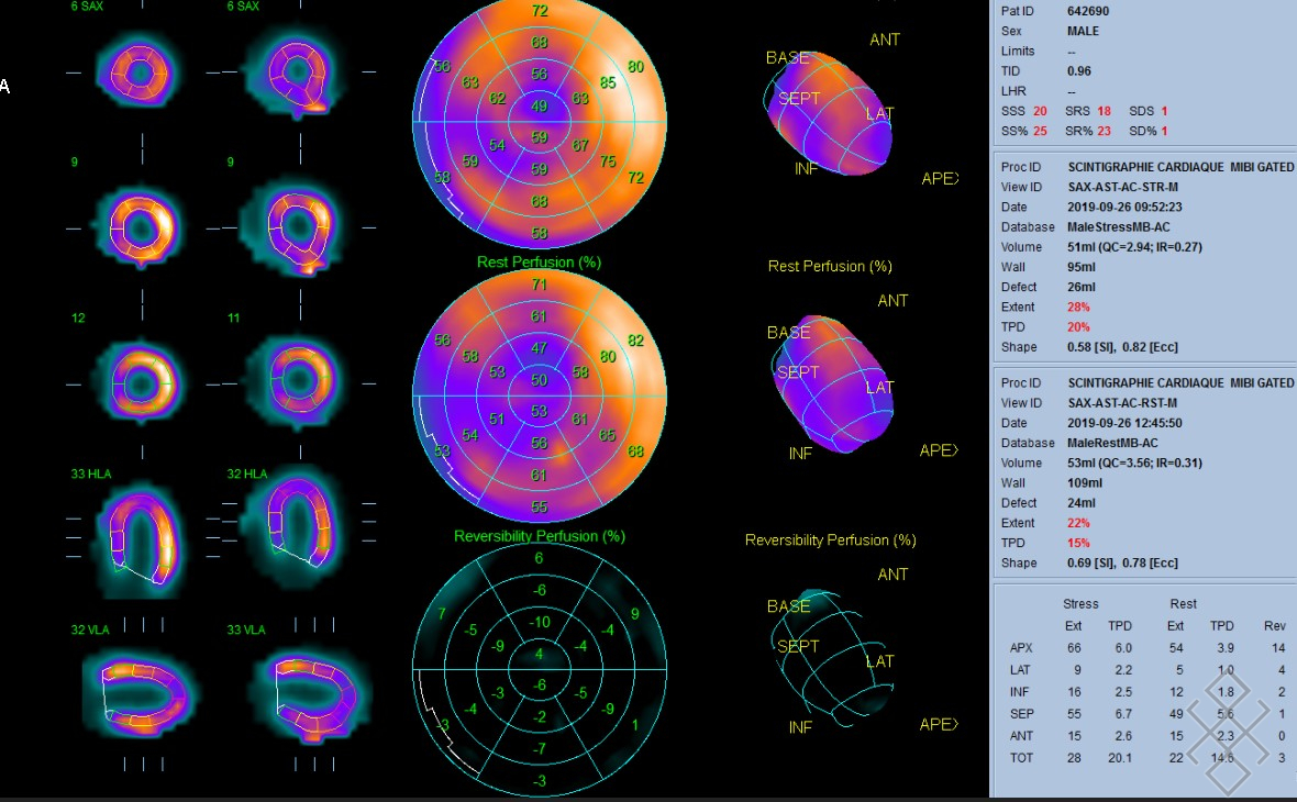 Scintigraphie Cardiaque - Définition & Déroulement - Prise de rdv en ligne