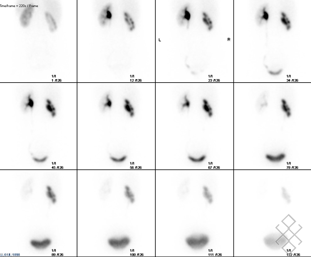 Scintigraphie Rénale - Définition & Déroulement - Prise de rdv en ligne