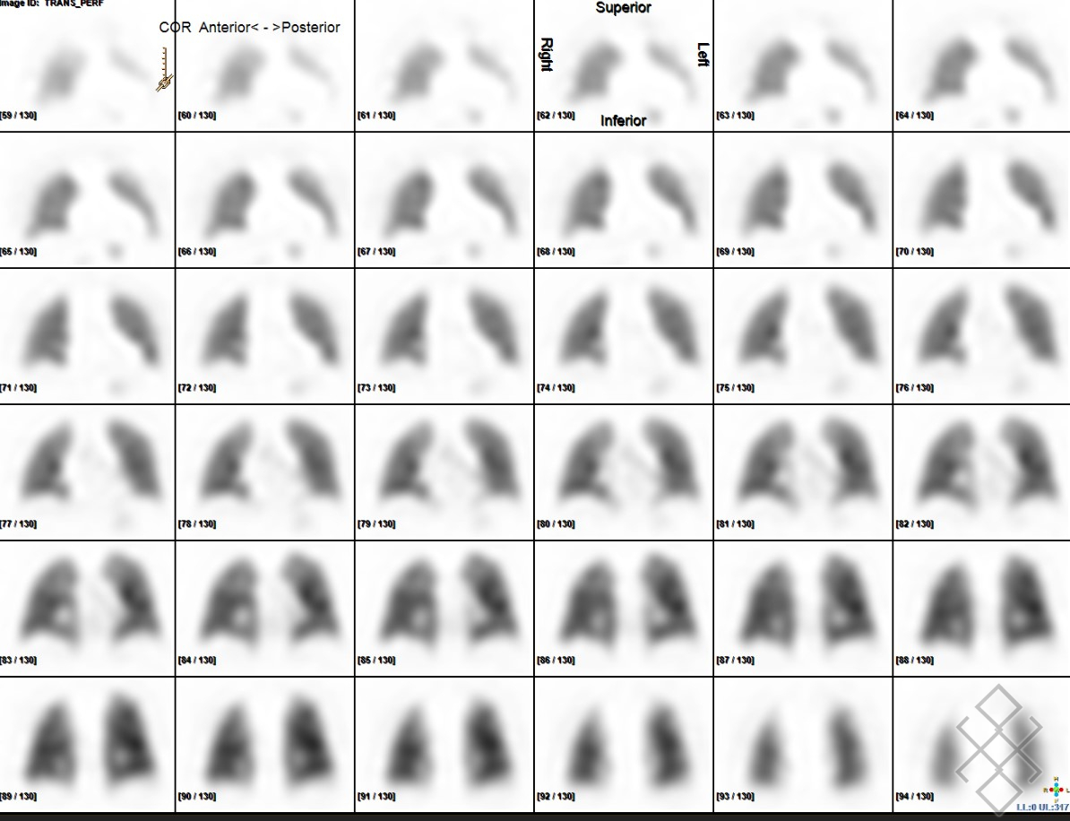 Scintigraphie Pulmonaire - Définition & Déroulement - Prise de rdv en ligne