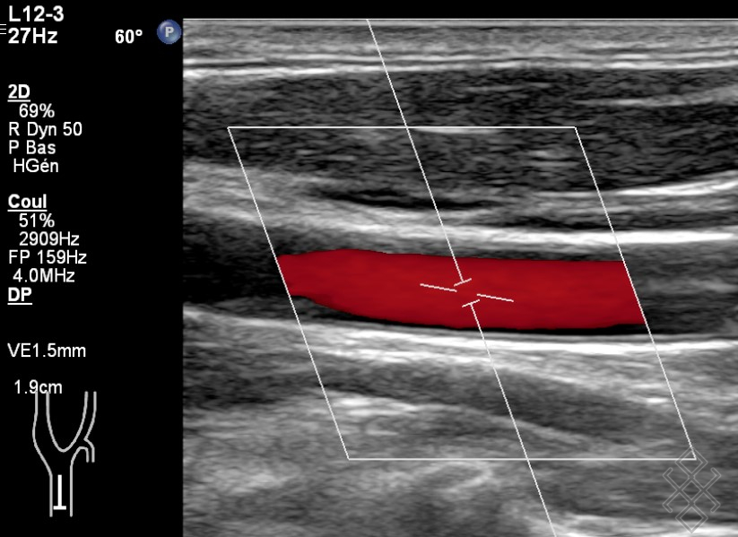 Échographie Doppler des Troncs Supra Aortique les bases pour bien ...