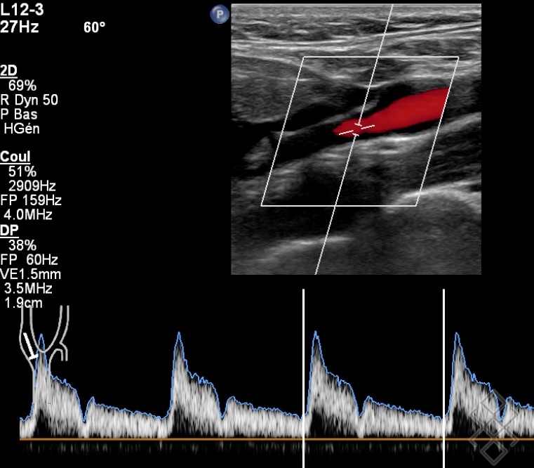 Doppler des Troncs Supra Aortiques (TSA) - Définition & Déroulement ...