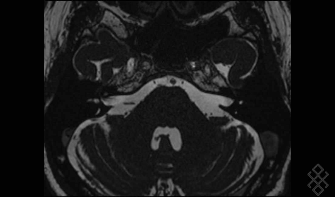 IRM des Conduits Auditifs Internes (CAI) - Définition & Déroulement ...