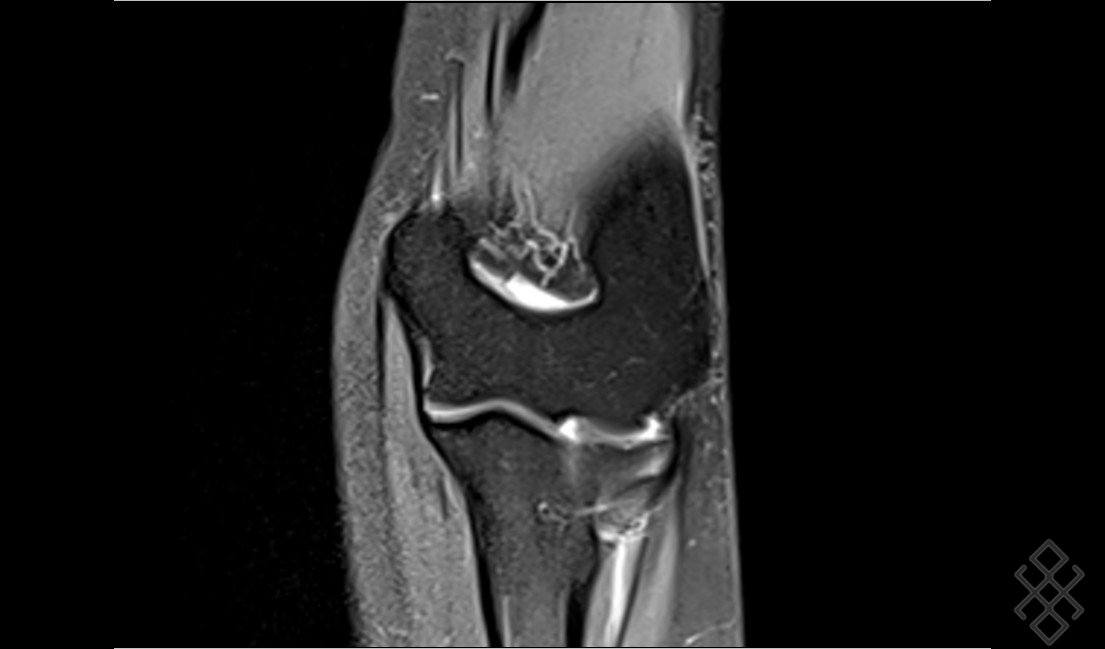 IRM du Coude - Définition & Déroulement - Prise de rdv en ligne