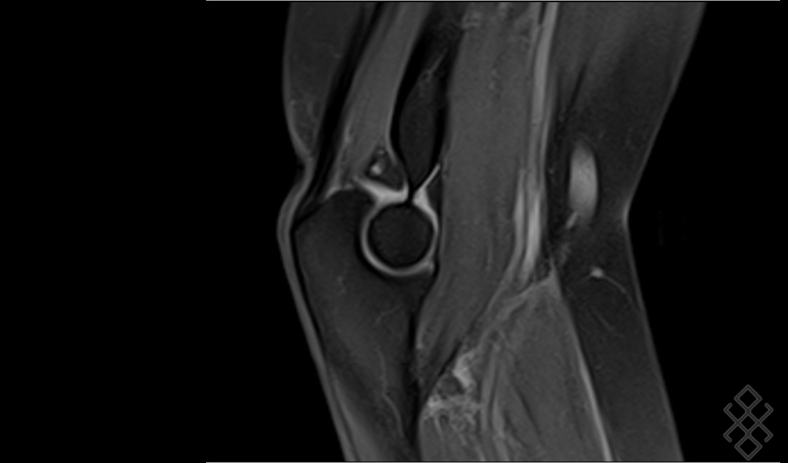 IRM du Coude - Définition & Déroulement - Prise de rdv en ligne