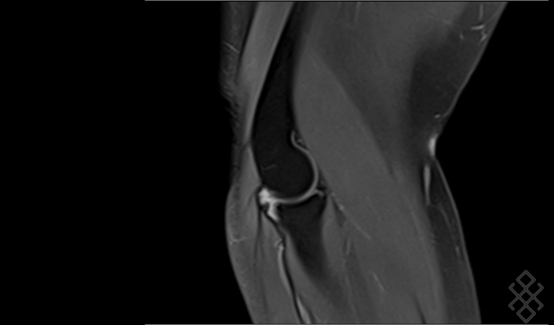 IRM du Coude - Définition & Déroulement - Prise de rdv en ligne