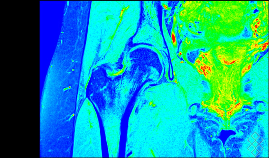 IRM de la Hanche - Définition & Déroulement - Prise de rdv en ligne