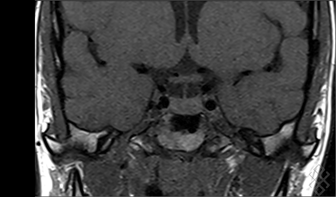 IRM de l’Hypophyse - Définition & Déroulement - Prise de rdv en ligne