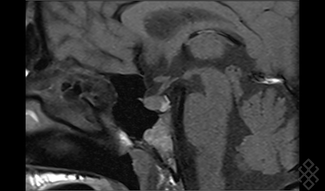 IRM de l’Hypophyse - Définition & Déroulement - Prise de rdv en ligne