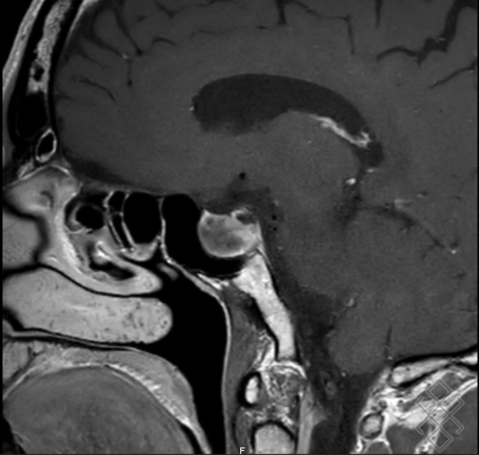 IRM de l’Hypophyse - Définition & Déroulement - Prise de rdv en ligne