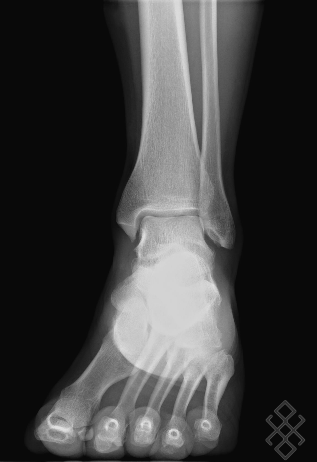 Radiographie de la Cheville - Définition & Déroulement - Prise de rdv ...