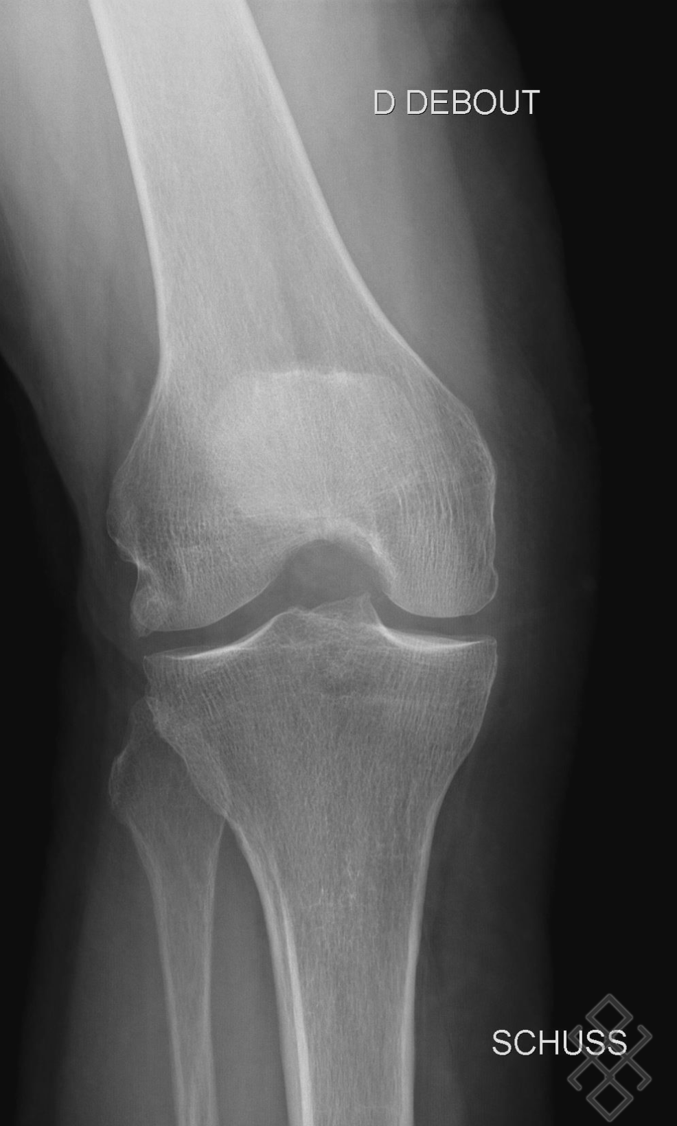 Radiographie du Genou - Définition & Déroulement - Prise de rdv en ligne