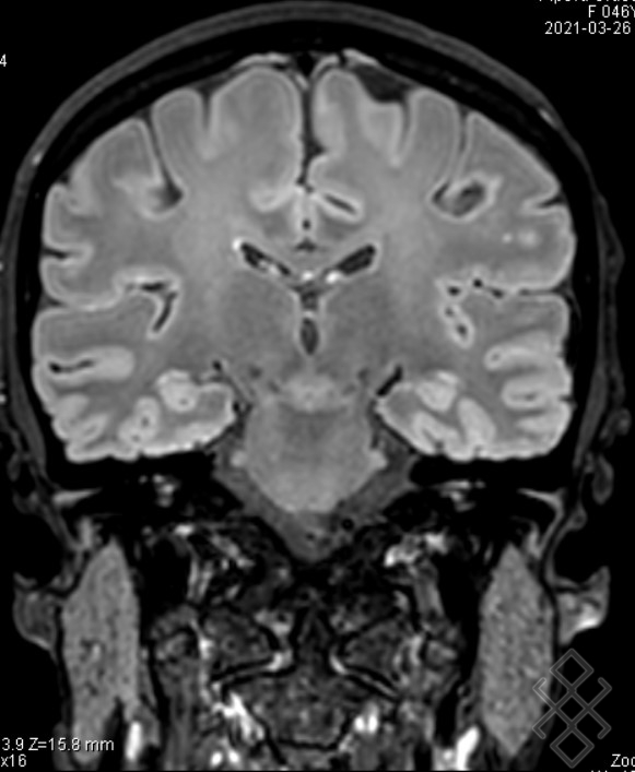 IRM Cérébrale - Définition & Déroulement - Prise de rdv 100% en ligne