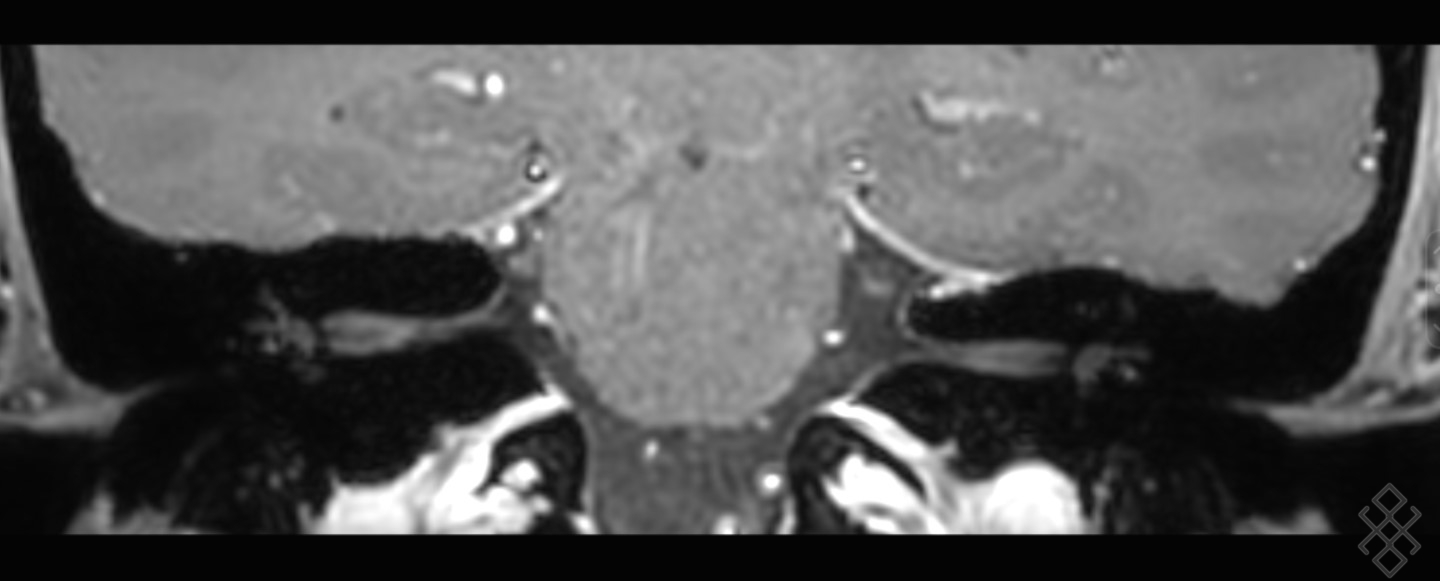 IRM des Conduits Auditifs Internes (CAI) - Définition & Déroulement ...