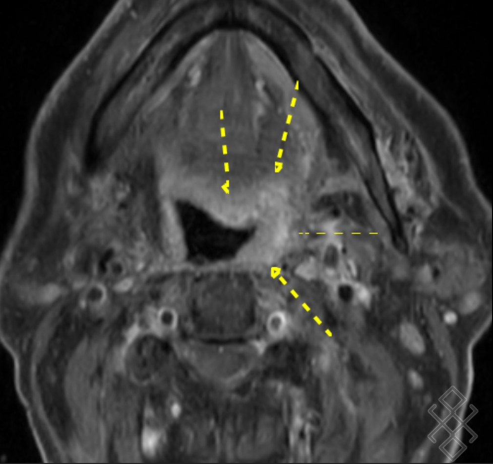 IRM des Tissus mous du Cou (ORL) - Définition & Déroulement - Prise de ...