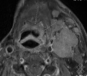 IRM des Tissus mous du Cou (ORL) - Définition & Déroulement - Prise de ...