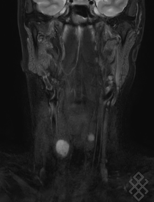 IRM des Tissus mous du Cou (ORL) - Définition & Déroulement - Prise de ...