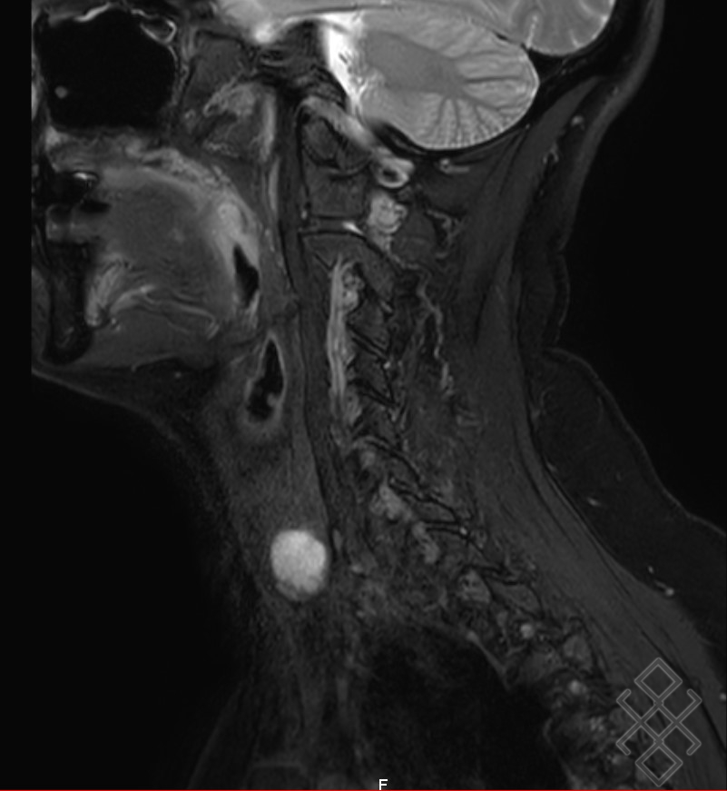 IRM des Tissus mous du Cou (ORL) - Définition & Déroulement - Prise de ...
