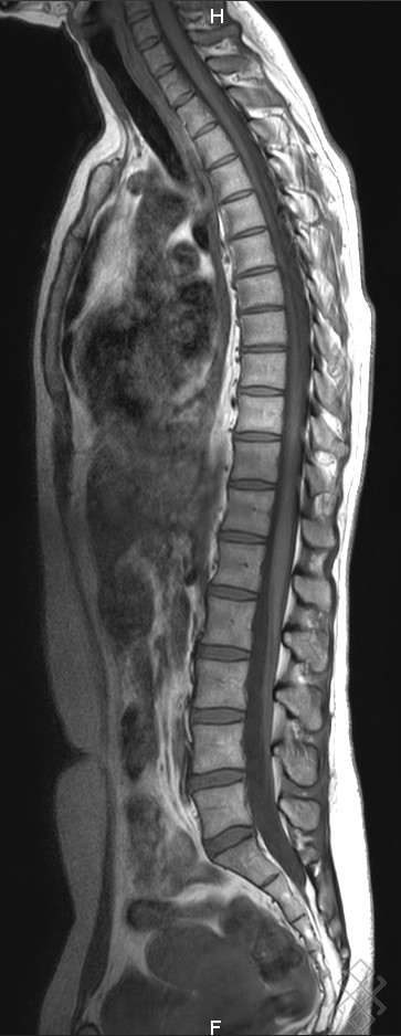 IRM du Rachis dorsal - Définition & Déroulement - Prise de rdv 100% en ...