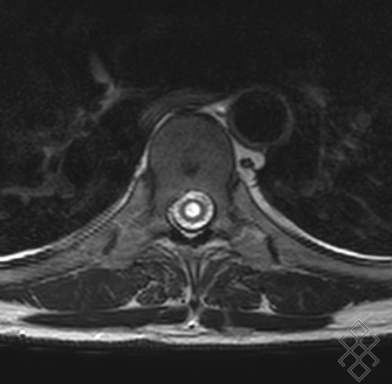 IRM Médullaire - Définition & Déroulement - Prise de rdv en ligne