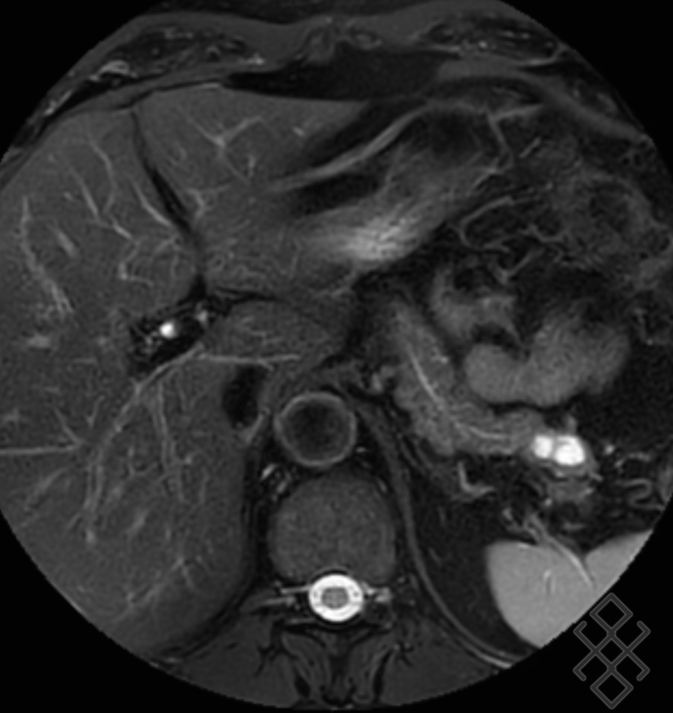 IRM Hépatique - Définition & Déroulement - Prise de rdv en ligne