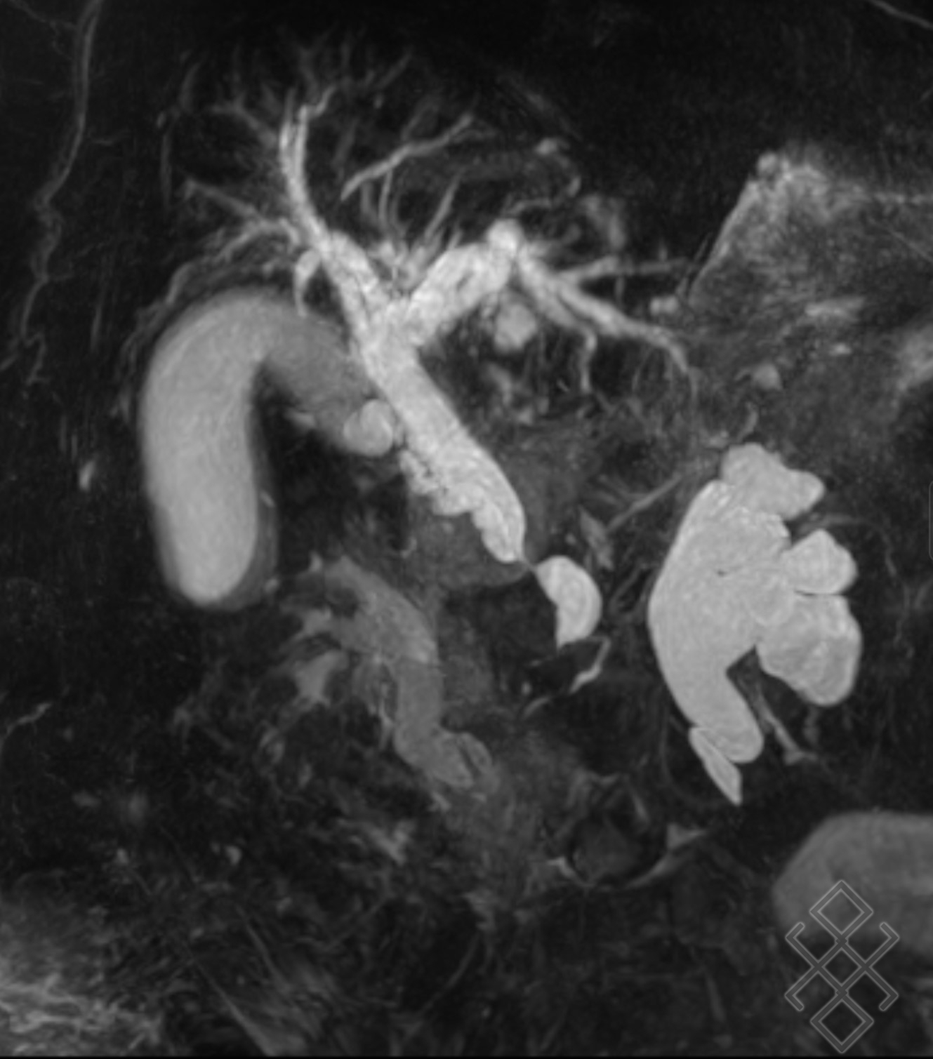 Bili-IRM (Cholangio-IRM) - Définition & Déroulement - Prise de rdv en ligne